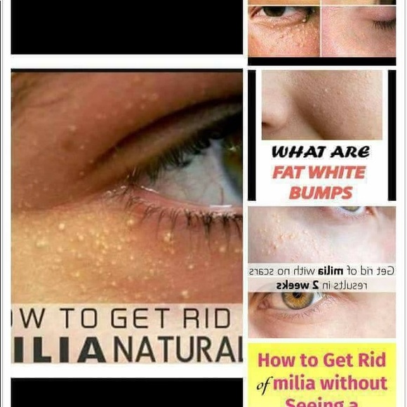 Syringoma | Skincare | Syringoma Cream Remove Syringoma 0 Effective ...